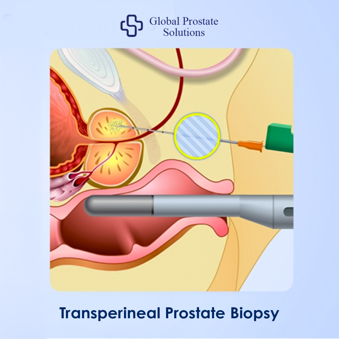 What is a Prostate Biopsy | LATP Biopsy: Benefits & Risks
