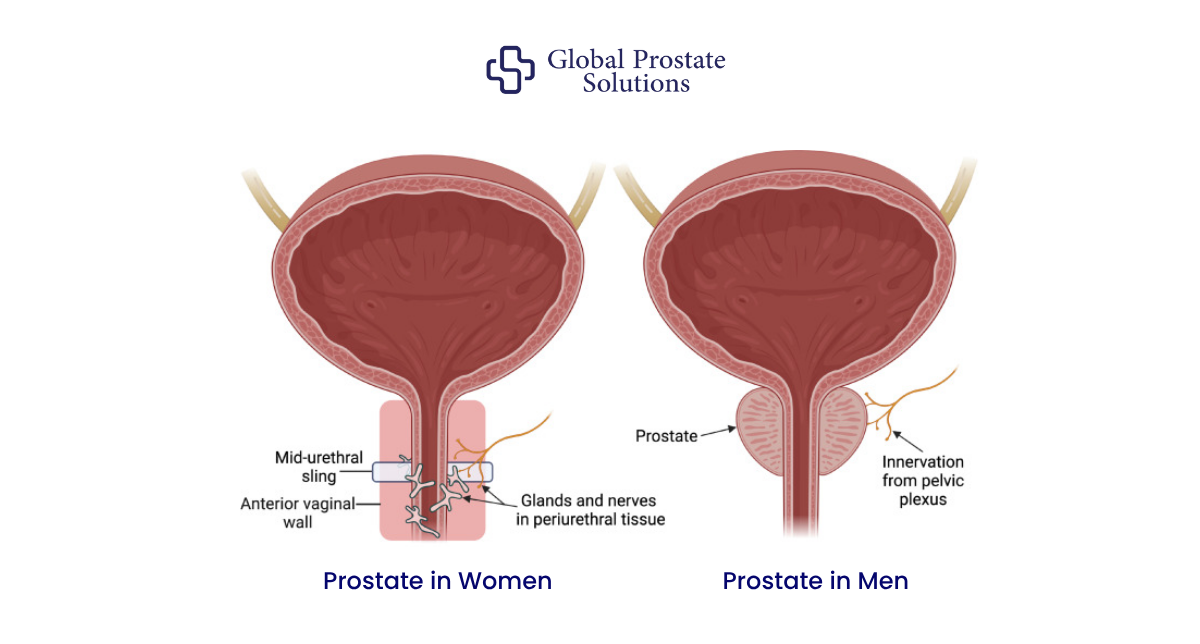 Can Women Get Prostate Cancer | Prostate Cancer in Women